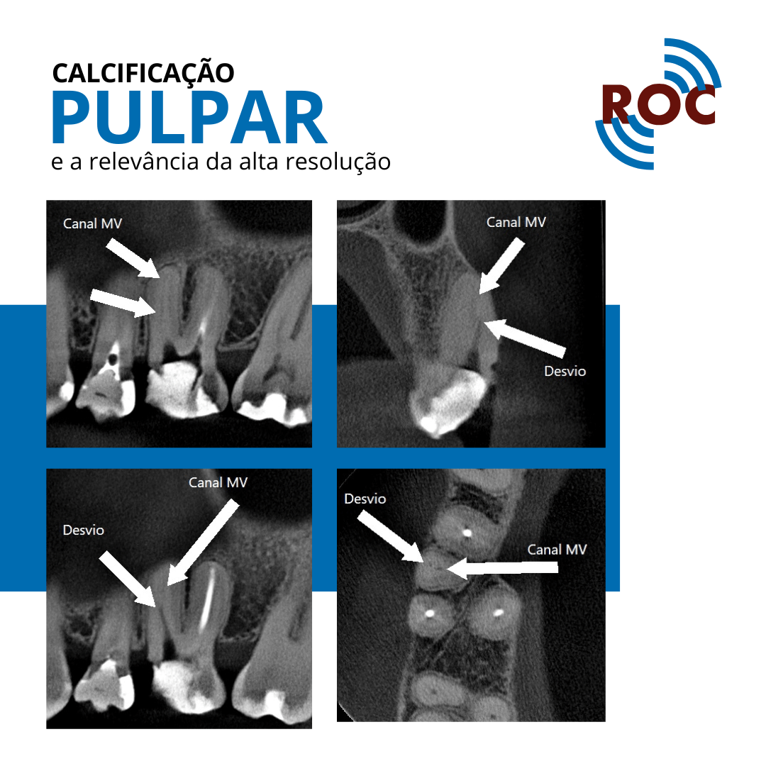 Calcificação Pulpar e a Relevância da Alta Resolução - ROC